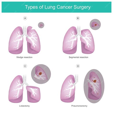 Premium Vector Types Of Lung Cancer Surgery Illustration The Lung 4