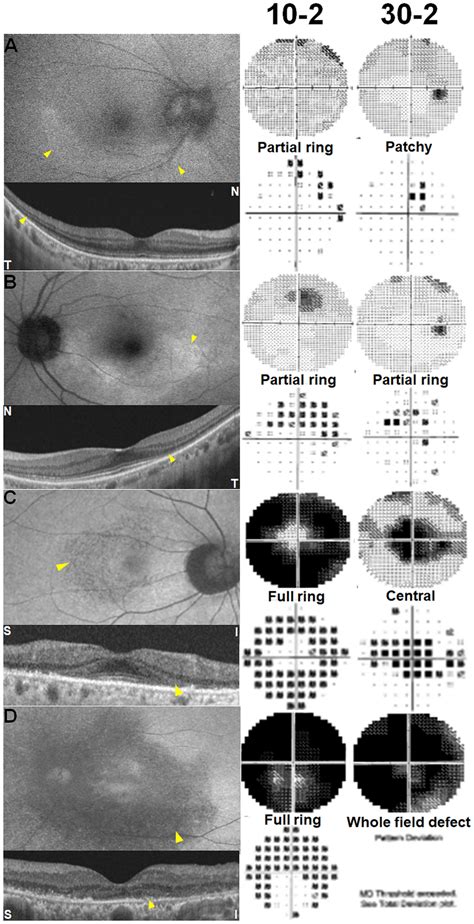 Representative Examples Of Scotoma Patterns Noted In 10 2 And 30 2