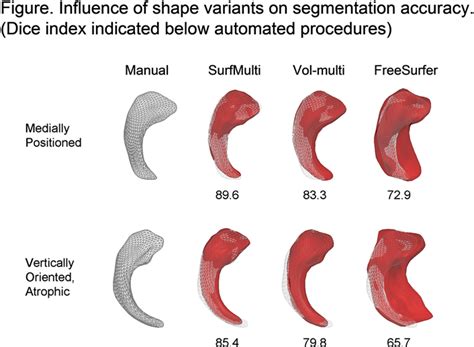 Robust Automatic Hippocampal Segmentation In Temporal Lobe Epilepsy
