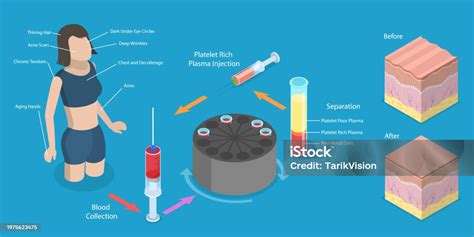 Prp 절차의 3d 등각 투영 평면 벡터 개념 그림 Platelet Rich Plasma에 대한 스톡 벡터 아트 및 기타 이미지
