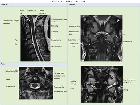 Cervical Spine Trauma Radiología English Edition