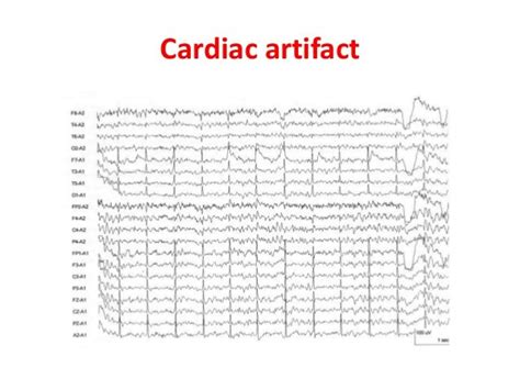 Eeg Artifacts