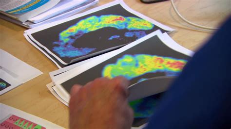 How To Prevent Alzheimers Disease Cnn Video