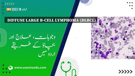 Diffuse Large B Cell Lymphoma Dlbcl Uses In Urdu