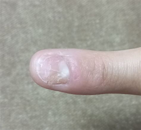 손톱 물어뜯는 버릇 지식in
