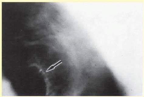 Ciliochoroidal Effusion Ento Key