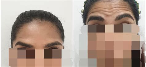 Best Botox In Dubai 2024 Dr Shehzadi Tasneem Sultan