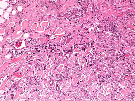 Dermatofibroma Of The Face A Clinicopathologic Study Of 20 Cases