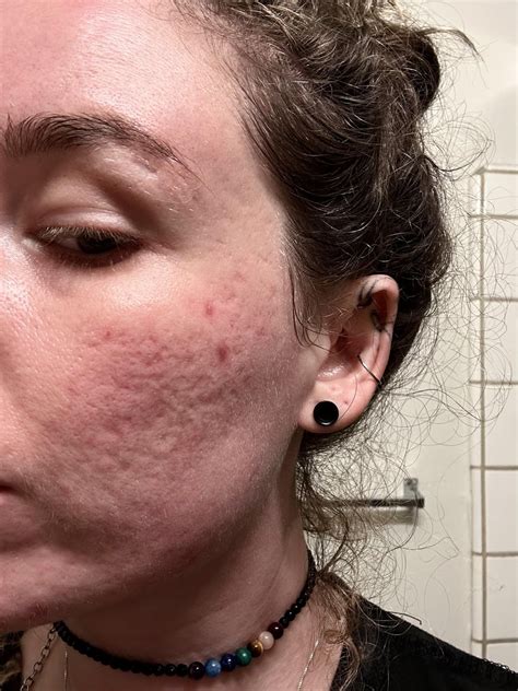 Treatmentdoctors Suggestions What Kind Of Scars Are Thesehow Bad