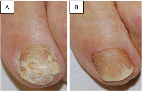 Nail Plate Appearance Before A And After B Onychomycosis Treatment Download Scientific