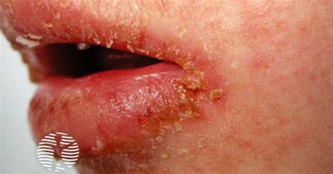 Angular Cheilitis Image