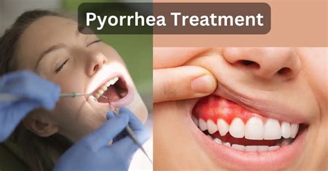 Effective Pyorrhea Treatment Symptoms Remedies And Costs