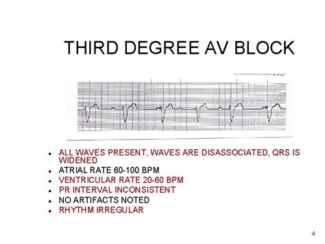 First Degree Av Block All Waves Present Normal