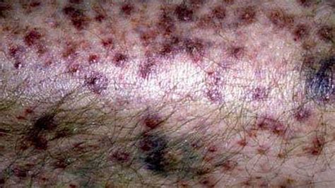 Scurvy Symptoms Risk Factors Treatment Recovery And More