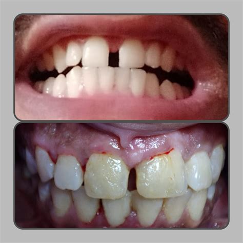 Front Teeth Gap Diastema Dental Treatment In Delhi