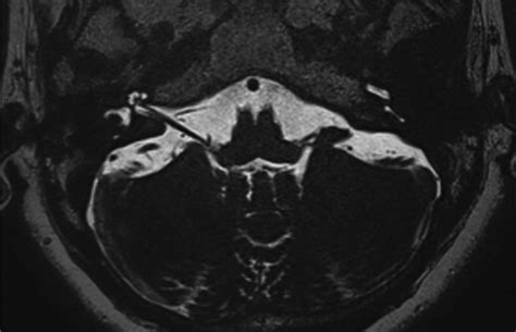 Magnetic Resonance Image Of A Right Sided Type 1a Vascular Loop In A