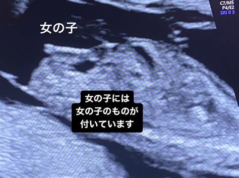 宋美玄🐰子宮体がん検診は実は不要です On Twitter ベビーナブについて質問がありましたので、妊娠12週の超音波検査で体の性別をどの