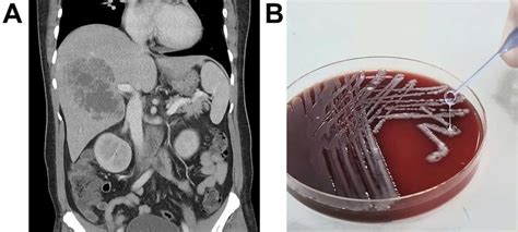 A Abdominal Computed Tomography Showing A Large Multiloculated Abscess