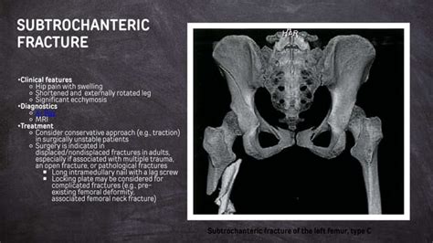 Proximal Femur Fracture Classification Ppt Pptx