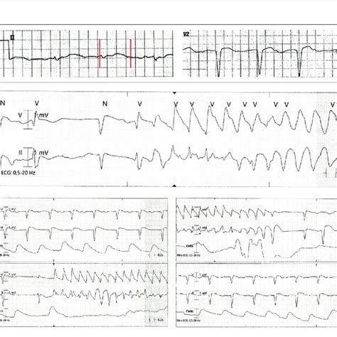 ECG Findings In Patient 3 A QTc Prolongation 530 Ms During Paced Download Scientific