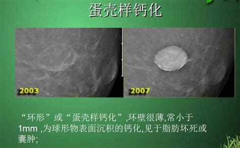 乳腺影像报告和数据系统（bi Rads）