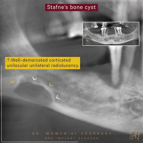 Momen Elshorbagy On Linkedin Stafnes Pseudo Bone Cyst Synonyms A