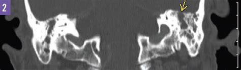 Mastoiditis As A Complication Of Untreated Otitis Media Consultant360