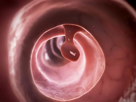 Some Colon Polyps Pose Greater Cancer Risk