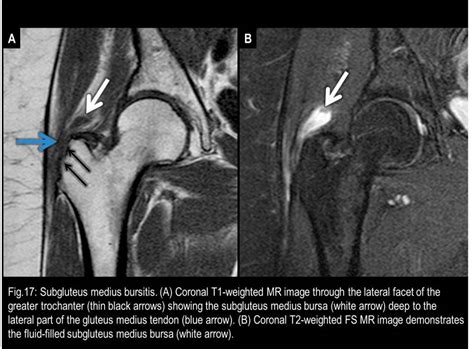 Subgluteus Medius Bursa Wikism Sports Medicine Wiki