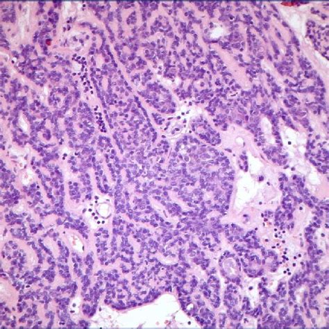 Scalp Lesions Confluent Erythematous Telangiectatic Nodules And Download Scientific Diagram