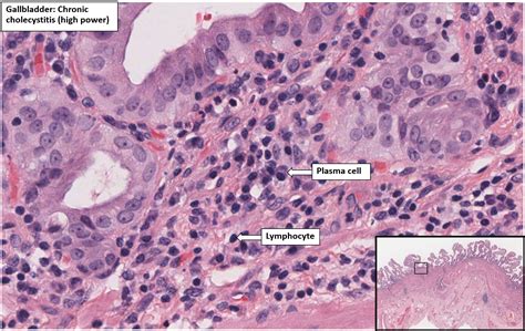 Gallbladder Chronic Cholecystitis Nus Pathweb