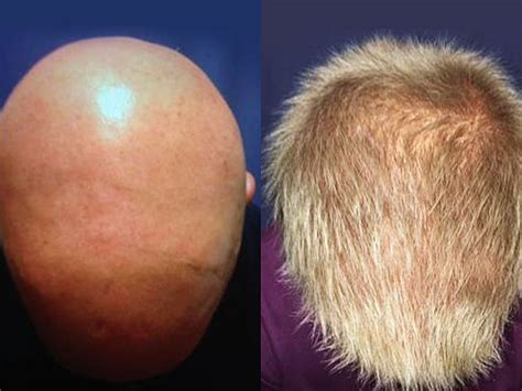 Fda Approved Drug Cured Patients With Alopecia Areata