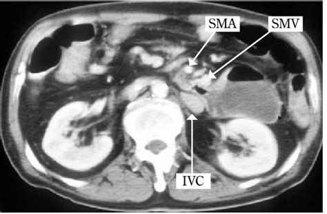 Abdominal Ct Indicated Total Situs Inversus Second Part Of The Download Scientific Diagram