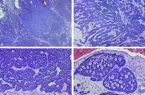 Sinonasal Basaloid Squamous Cell Carcinoma Shows A Variety Of Growth Download Scientific