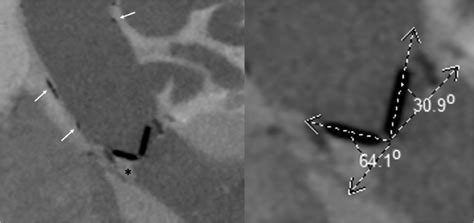 54‐year‐old Male With History Of Aortic Coarctation Status Post