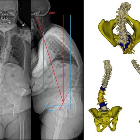 Global Spinal Sagittal Alignment Parameters Sva C7 Tilt Tpa T1spi Download Scientific Diagram