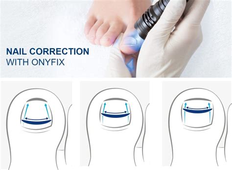 𝐖𝐡𝐚𝐭 𝐢𝐬 𝐎𝐧𝐲𝐟𝐢𝐱® Waterford Foot Clinic