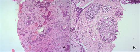 Histologic Picture Showing Arrangement Of Tumor Cells A Arranged In