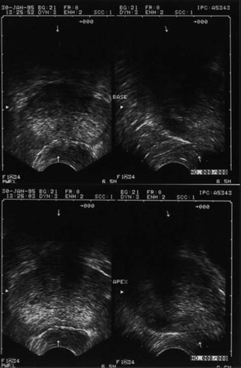 Prostate Anatomy Ultrasound