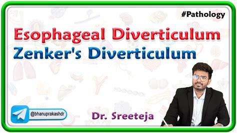 2 Esophageal Diverticulum Zenker S Diverticulum USMLE Step 1