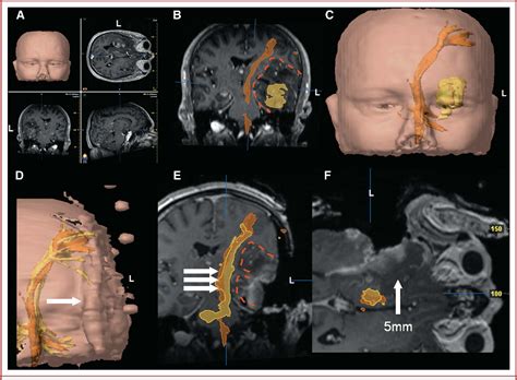 Figure 1 From Pre And Intraoperative Tractographic Evaluation Of Corticospinal Tract Shift