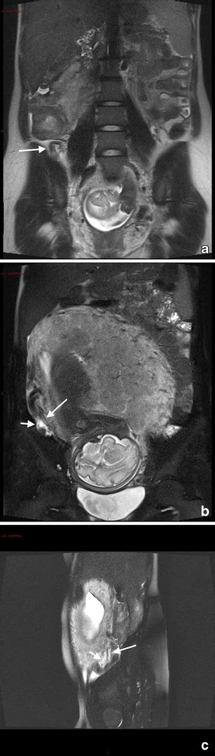Appendizitis Schwangerschaft Pacs