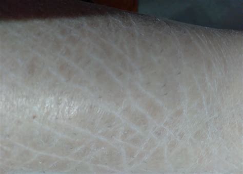 Erythroderma Ichthyosis R Ichthyosis