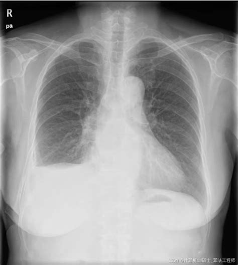 采用深度学习使用卷积神经网络（cnn）选择efficientnet预训练模型进行微调医疗图像数据集，处理训练应用ct，x光射线，核磁共振的主要疾病医疗图像数据集 Csdn博客