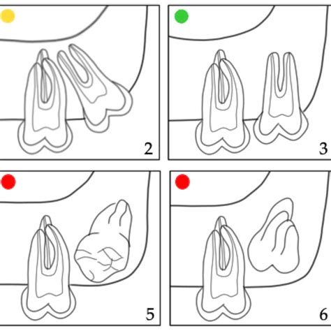 Winters Classification For The Inclination Of The Mandibular M3