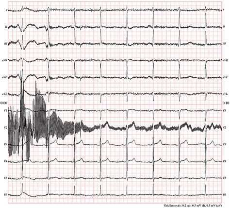 12 Lead ECG With 60 Hz PLI Seen In V2 The PLI With Varying Amplitude Download Scientific