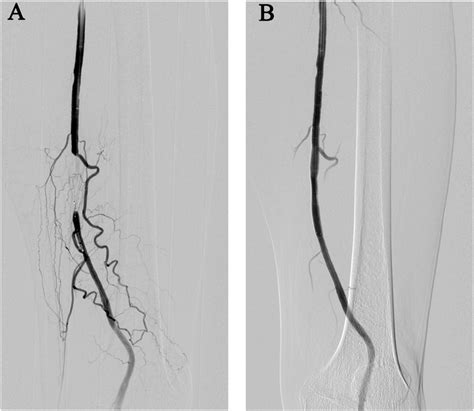 Left Sfa Occlusion And Stent Deployment A Dsa Left Sfa Occlusion