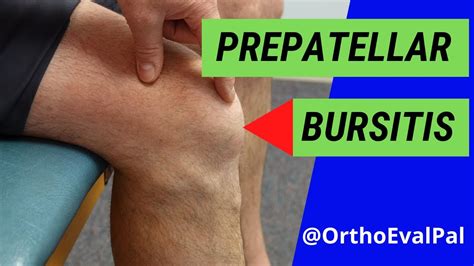How To Wrap A Knee With Bursitis At Lawrence Jacques Blog