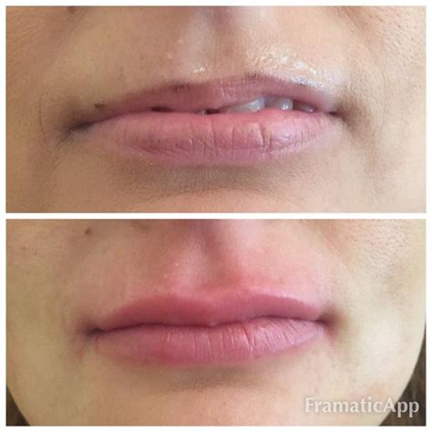 Lip Correction And Enhancement Face Maker Aesthetics