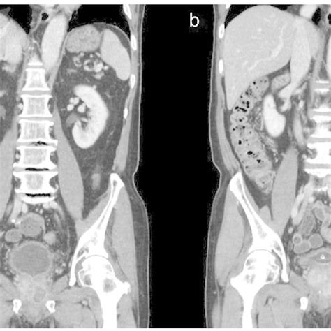 Abscess Drainage With Transurethral Resection Of The Prostate